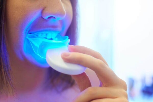 Welche Bleaching Möglichkeiten gibt es für zuhause?